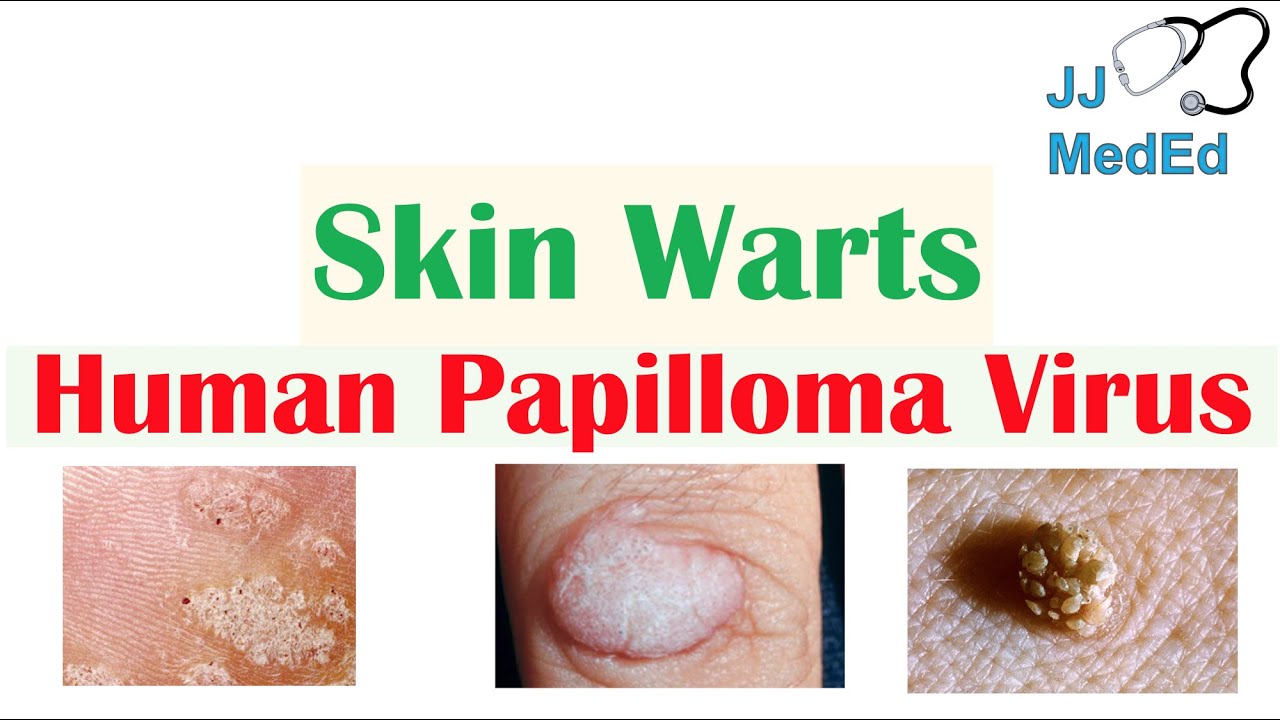 Overview of Skin Warts (Verrucae) | What Causes Them? Who Gets Them ...